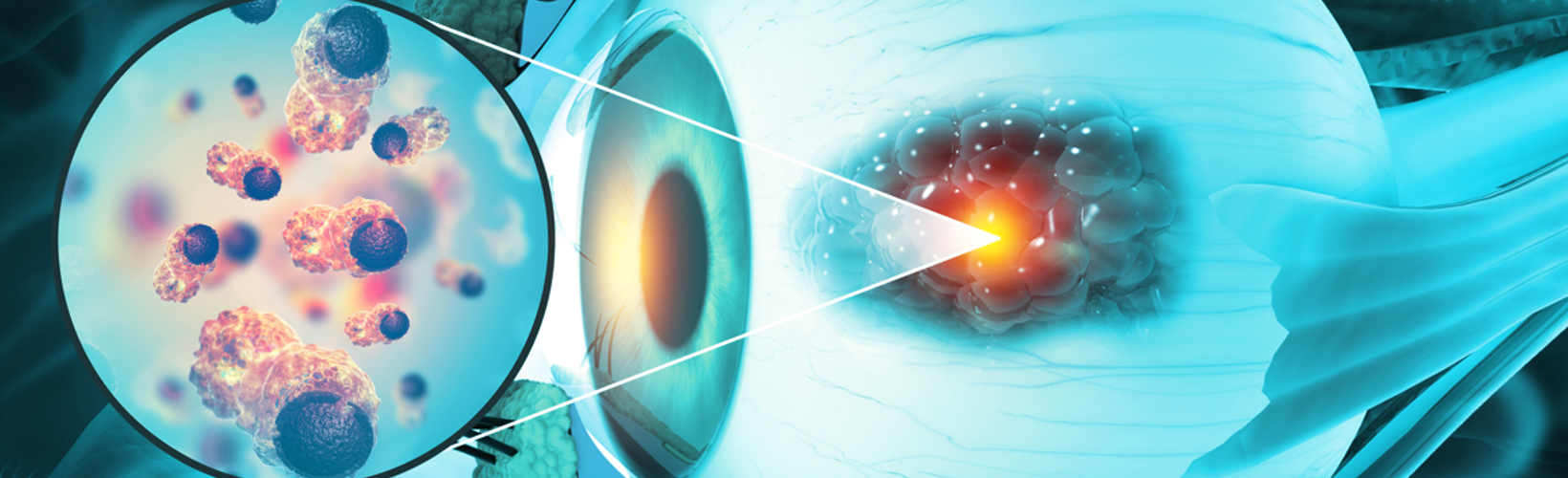 ESCRS - Periocular Cancer Treatment: From Control to Prevention